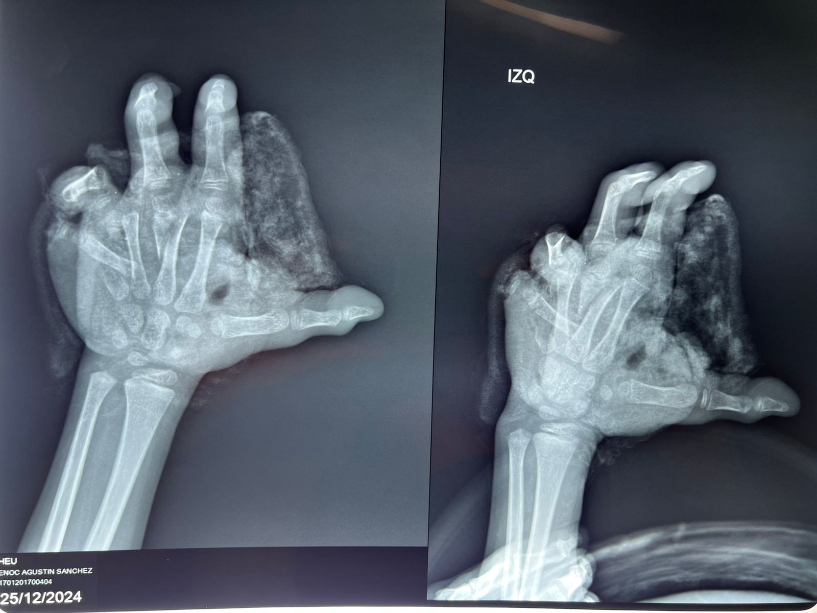 Por manipulación de pólvora, menor de siete años perdió dos dedos de su ...